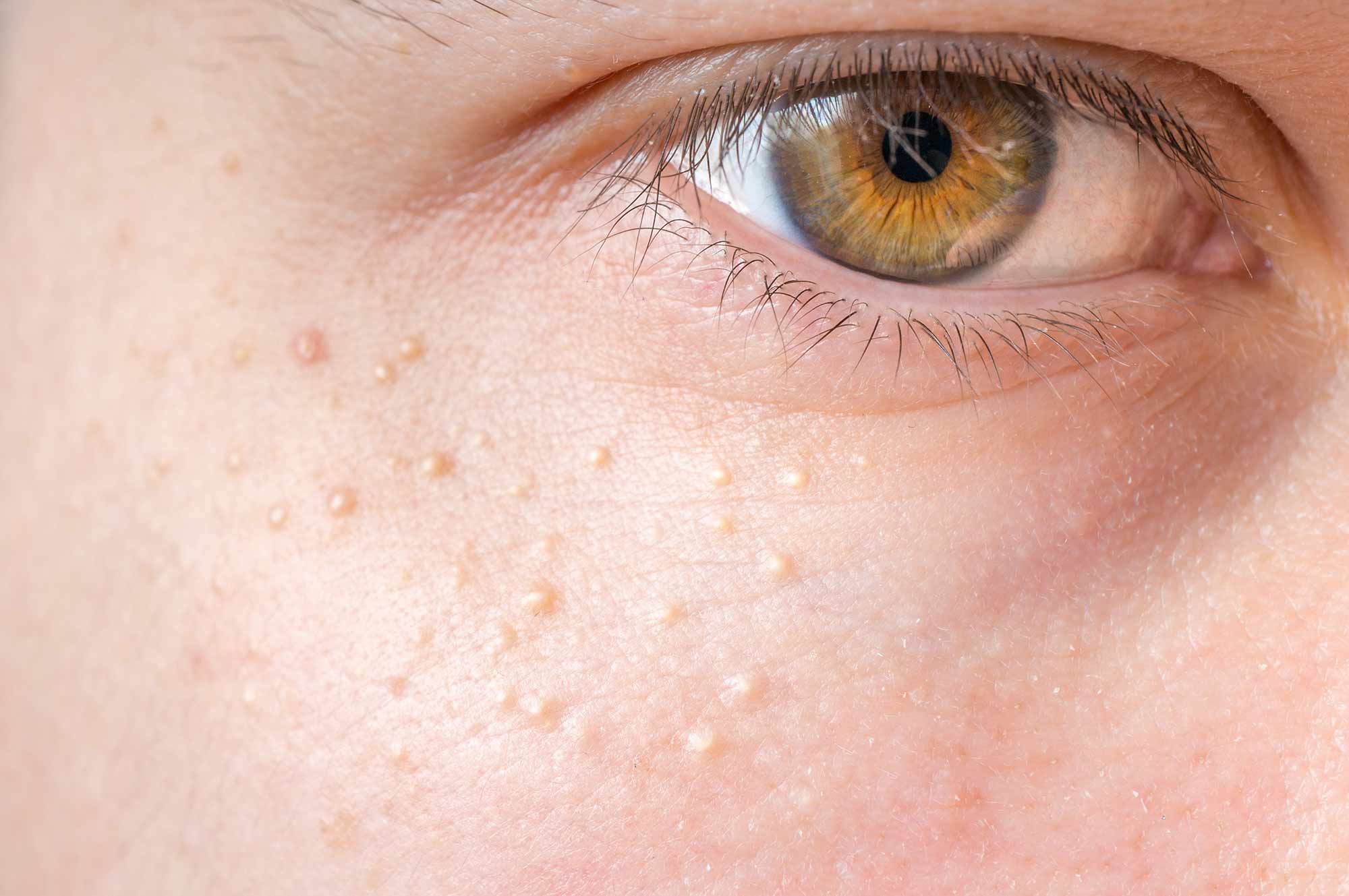 Getting Milia and Milk Spot Removal | Causes, Removal and Prevention
